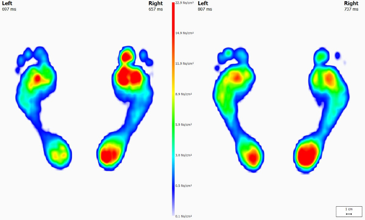 Gait Analysis: Understanding, Fixing Problems, and Optimising Performa ...
